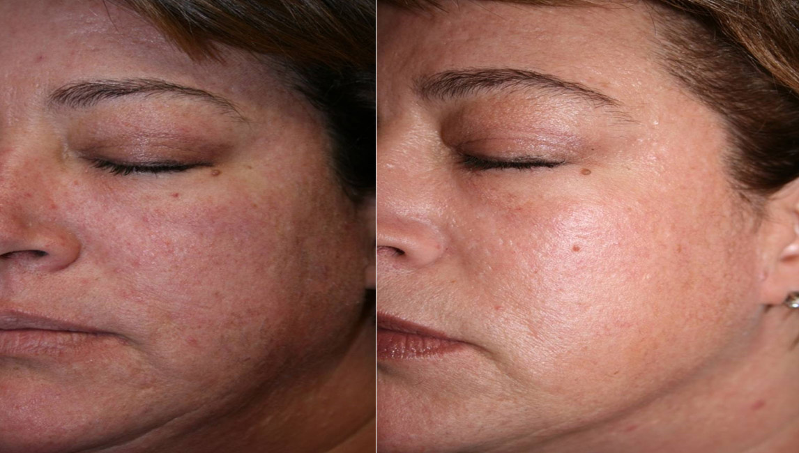 CoolPeel Laser Resurfacing NYC | Kállos Medical Aesthetics